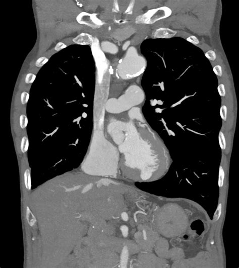 070h 80m Lv Diverticulum Vs Pseudoaneurysm The Common Vein