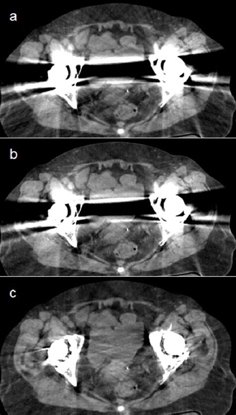 Figure 1 From Metal Artifact Reduction For Total Hip Prosthesis In