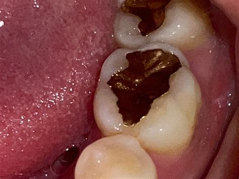 인레이한 치아 파절 크랙 지식in