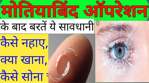 Eye Drops After Cataract Surgery Australia At Wanda Heckart Blog