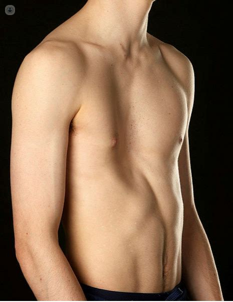 Pectus Excavatum Medicína A Chirurgia