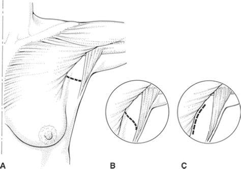 Axillary Node Biopsy And Axillary Node Dissection Basicmedical Key