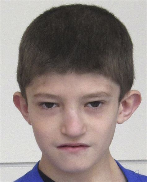 Figure Mild Dysmorphic Facial Features Of A Boy Aged 11 Years With