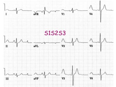 Ecg Reading