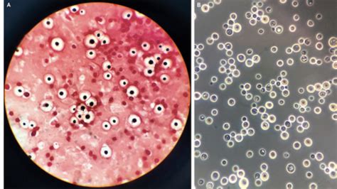 Criptococosis Quizlet