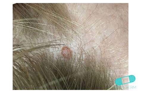 Online Dermatology Intradermal Nevus