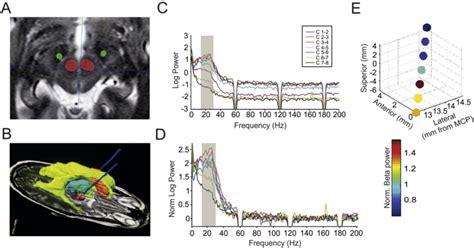 Beta Oscillatory Activity At The Subthalamic Nucleus Of Dbs Implanted
