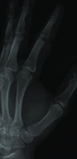 Preoperative Oblique Radiograph Of Left Hand Demonstrated Radial Sided