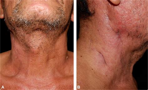 Nontuberculous Scrofuloderma With Sweet Syndrome Leading To Anti