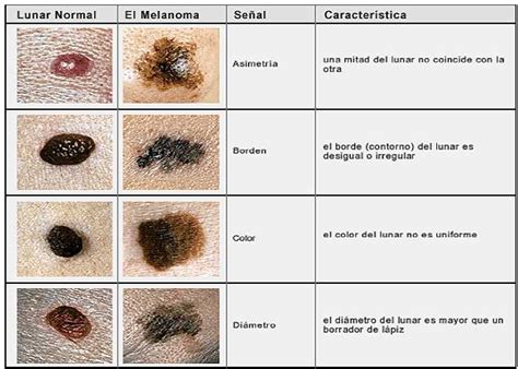 ¿lunar Normal O Melanoma