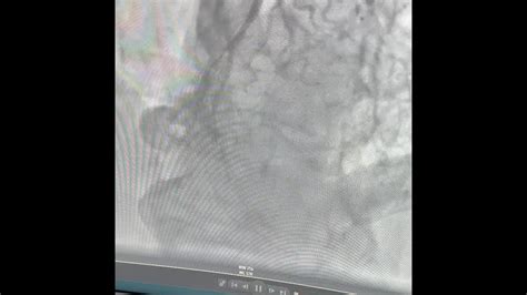 Joseph Hanna On Linkedin Long Rca Cto From Proximal To Crux Extending To Bifurcation Primary…