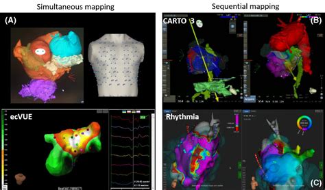 Grid Mapping Catheter For Ventricular Tachycardia Ablation 49 Off