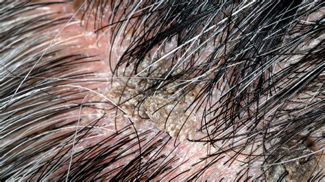 Warts On Scalp