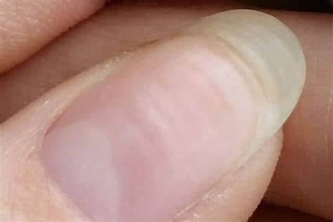 Beaus Lines On Nails What They Are And How To Treat Them Scratch