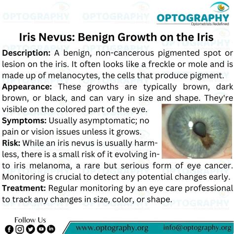 Optography On Linkedin Irisnevus Irisnevi Iris Eyeshealth