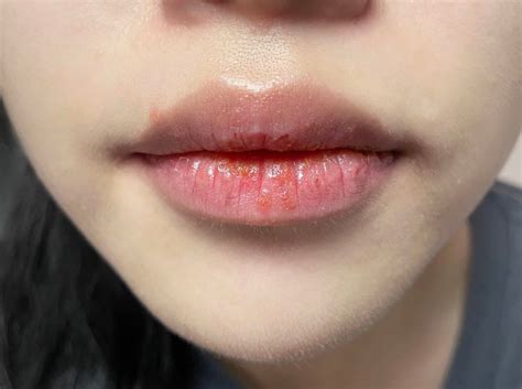 입술 구순염 피부염 지식in