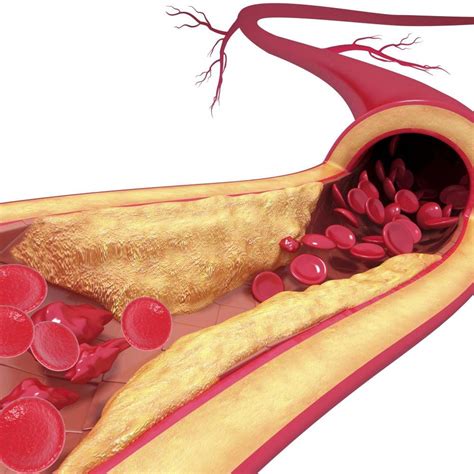 Arterioskleroza Simptomat Diagnostifikimi And Trajtimi