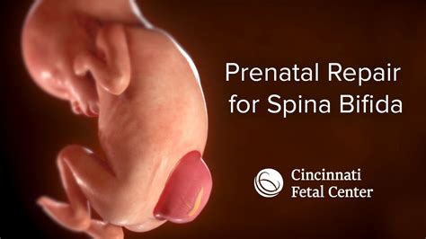 Spina Bifida