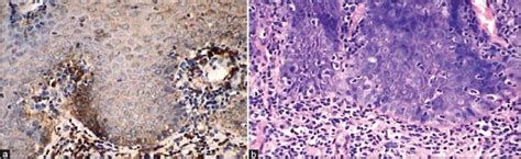 A Ihc Shows Intensemarked Cathepsin D Expression In Relation To Download Scientific Diagram