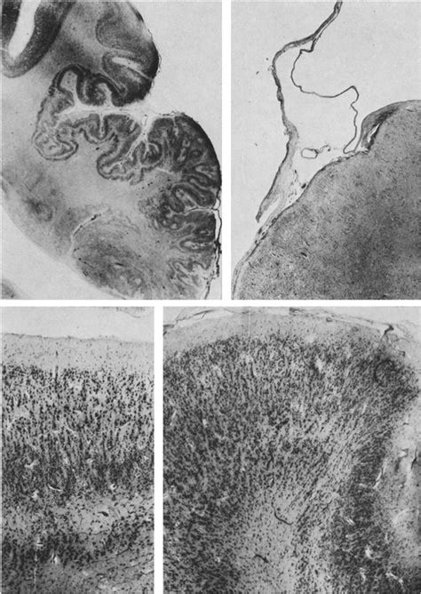 A Lip Of Cerebral Defect Case 1 Normal Cortex Present Superiorly Download Scientific