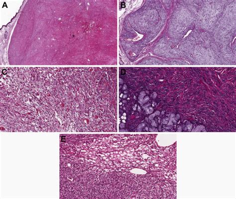 Clinicopathologic And Immunohistochemical Features Of Five New Cases Of