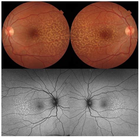 Optical Coherence Tomography In Inherited Macular Dystrophies A Review