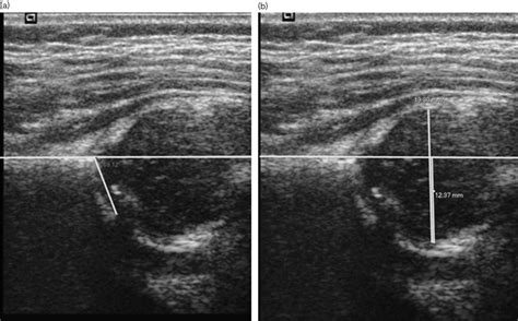Values For Bony Acetabular Roof Angle And Percentage Femoral