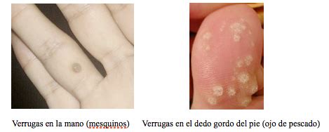 Infogen Virus Del Papiloma Humano