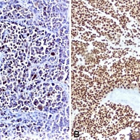Immunostaining With Nuclear Markers In Nodular Melanoma A S100