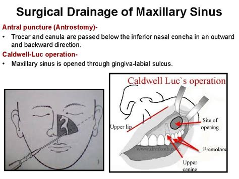 Paranasal Air Sinuses Presented By Dr Sushma Tomar