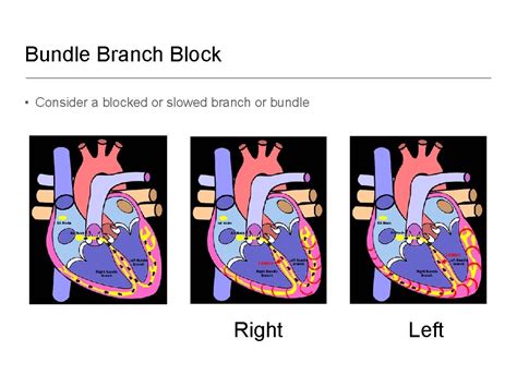 Ventricular Conduction Disturbances Chapter Bundle Branches Normal