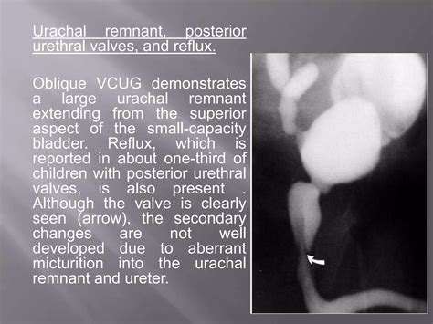 Mcu Micturating Cysto Urethrogram Pptx