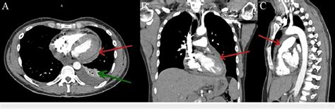 A Ct Pe Protocol Transverse View Of Thorax On January 2022 Red Arrow Download Scientific