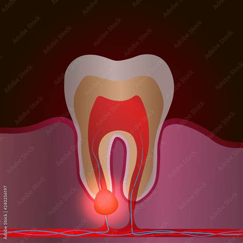 Dental Disease With Pain And Inflammation Medical Illustration Of