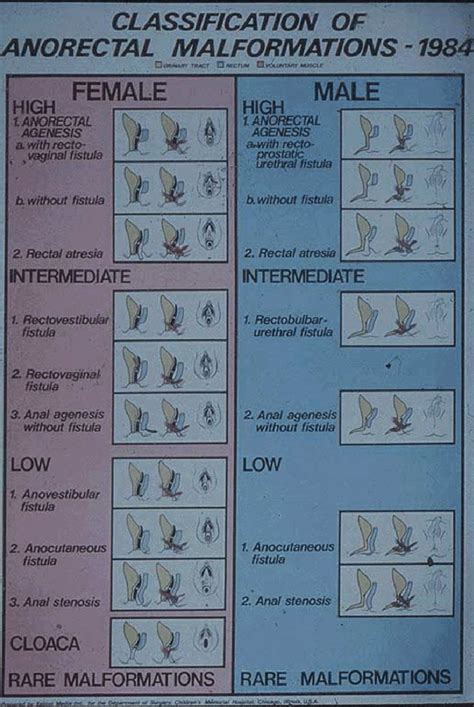 Classification Of Anorectal Malformations 1984 Wingspread