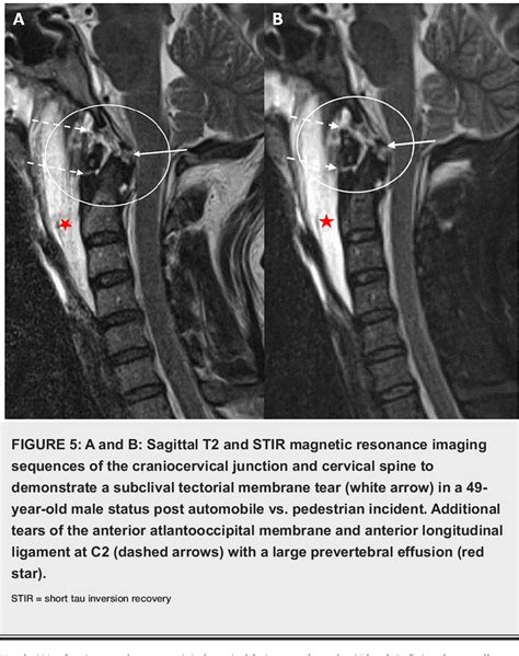 Tectorial Membrane Mri