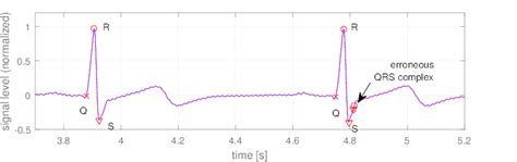 signal and detected qrs peaks for two qrs complexes after pan tompkins