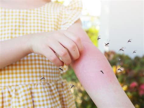 Why Mosquito Bites Itch