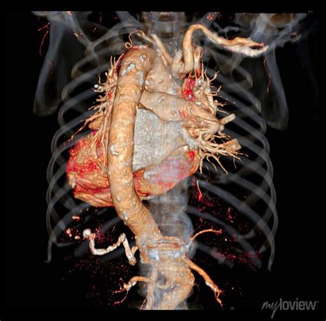 Cta Thoracic Aorta 3d Rendering Image Posterior View Or Back Wall Mural