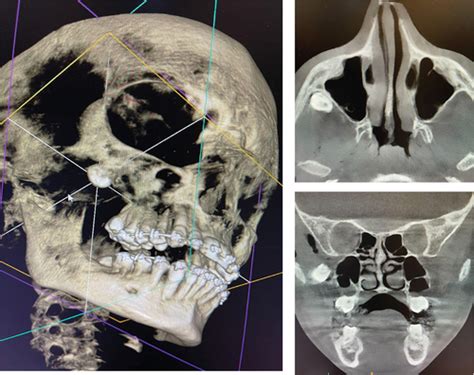 Maxillary Third Molar Anatomy Full Article C E Credit Maxillary