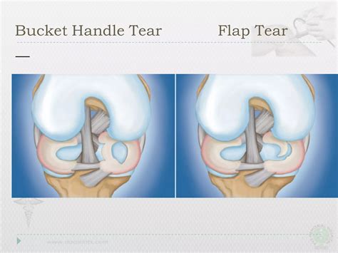 Meniscus Repair Vs Meniscectomy Pdf