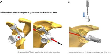 Clinical And Radiologic Outcomes Of Lima Promade Custom 3d Printed