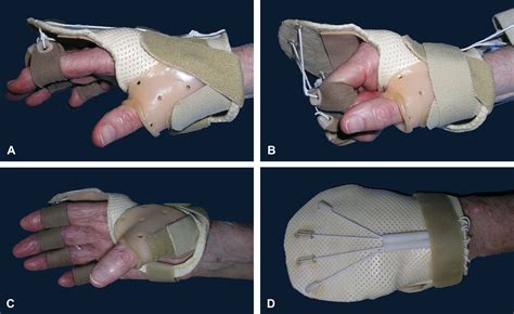 Hand Based Radial Gutter Splint Pattern At Johnny Duffy Blog