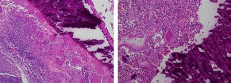 Actinomyces Als Seltene Ursache Einer Appendizitis