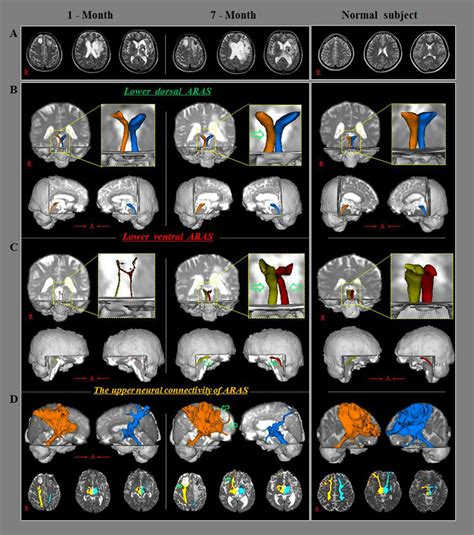 Brain Magnetic Resonance Images Mri And Diffusion Tensor Tractography