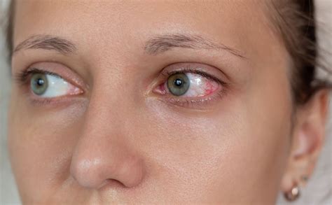 Queratitis Clínica Ocular Marcos