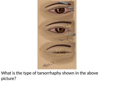 Tarsorrhaphy Pptx Pptx
