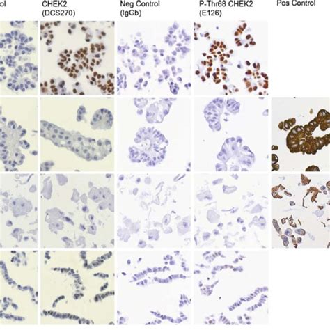 Absence Of Chek2 Protein Expression In Mutant Chek2 Breast Cancer Cell Download Scientific