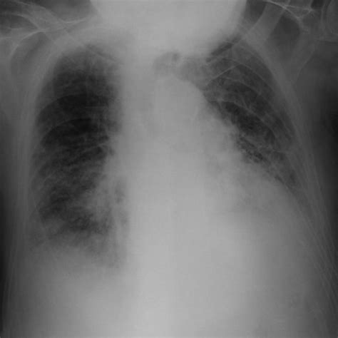 Pdf Human Infection By Pasteurella Canis A Case Report