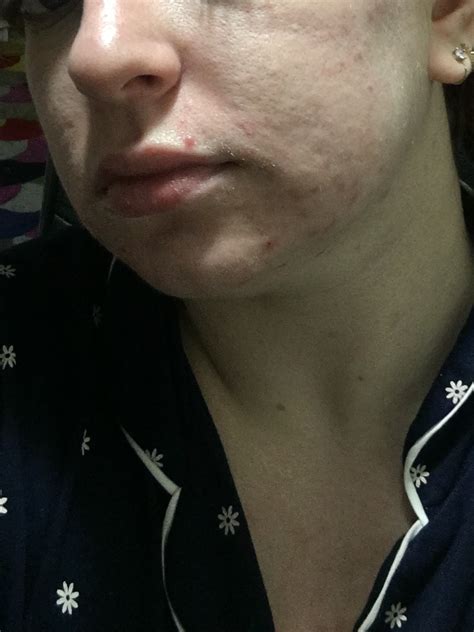 The Wonderful Wild Roaccutane Isotretinoin The First Sign Of Side